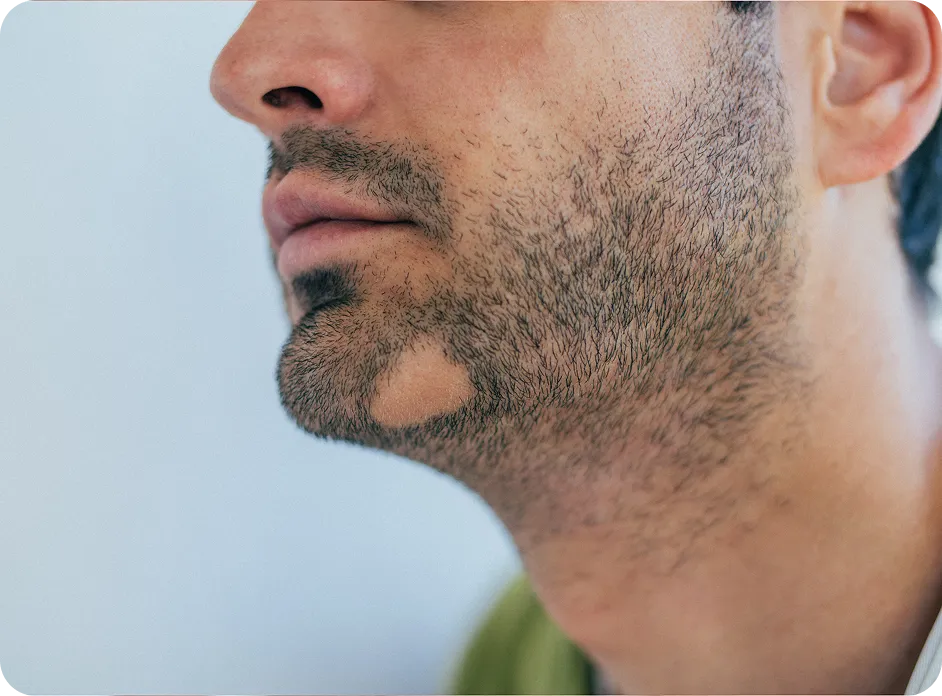 Trasplante de barba en Barcelona | jorgepasquier.com